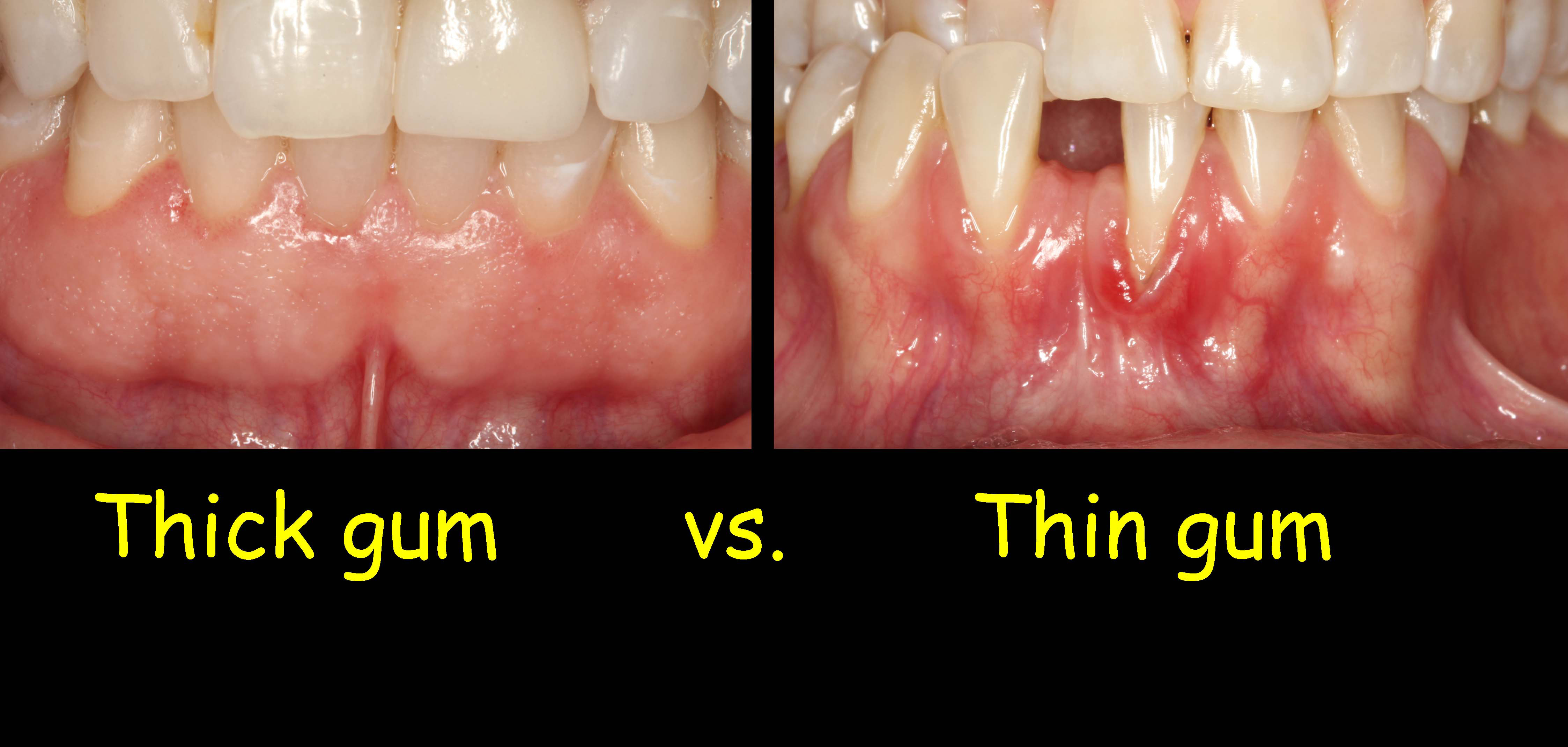 Thick Vs Thin Gum Capitol Hill Dentistry