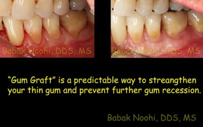 Thick vs. Thin gum: - Capitol Hill Dentistry