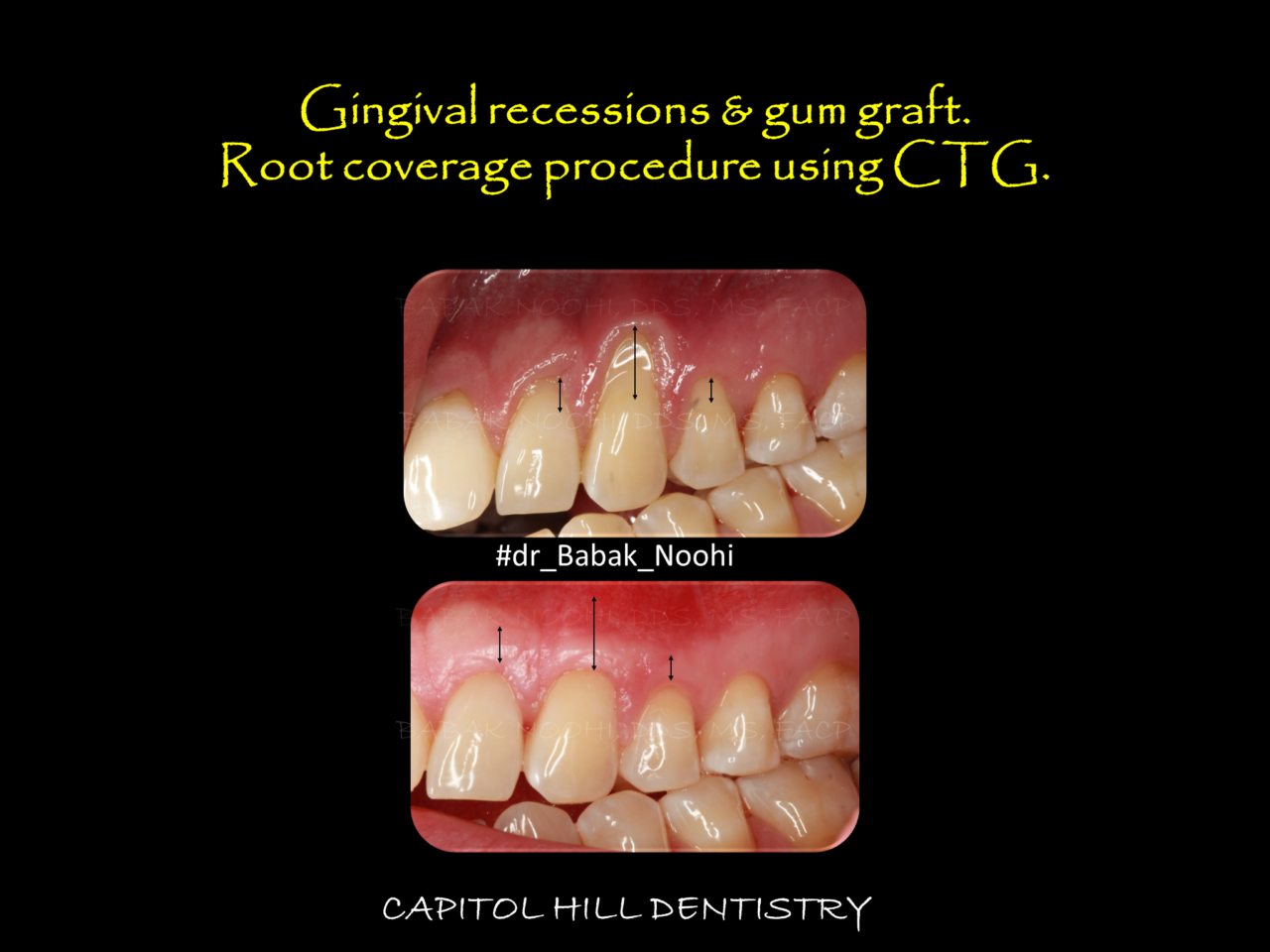 Thick vs. Thin gum: - Capitol Hill Dentistry