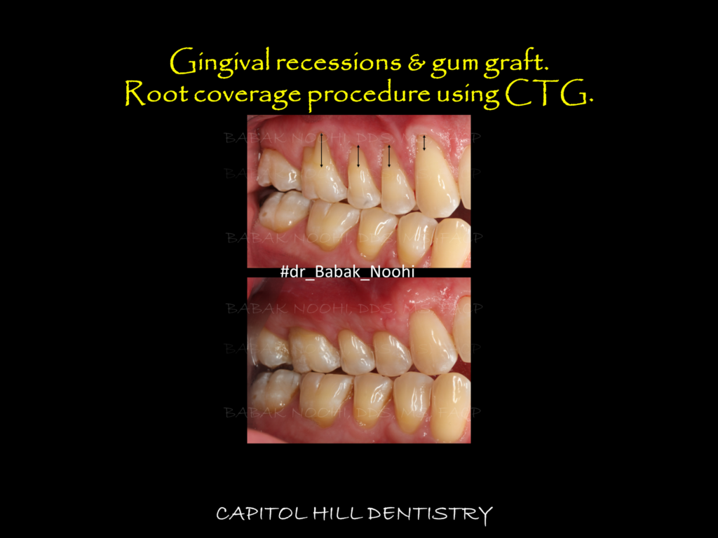 Thick vs. Thin gum: - Capitol Hill Dentistry