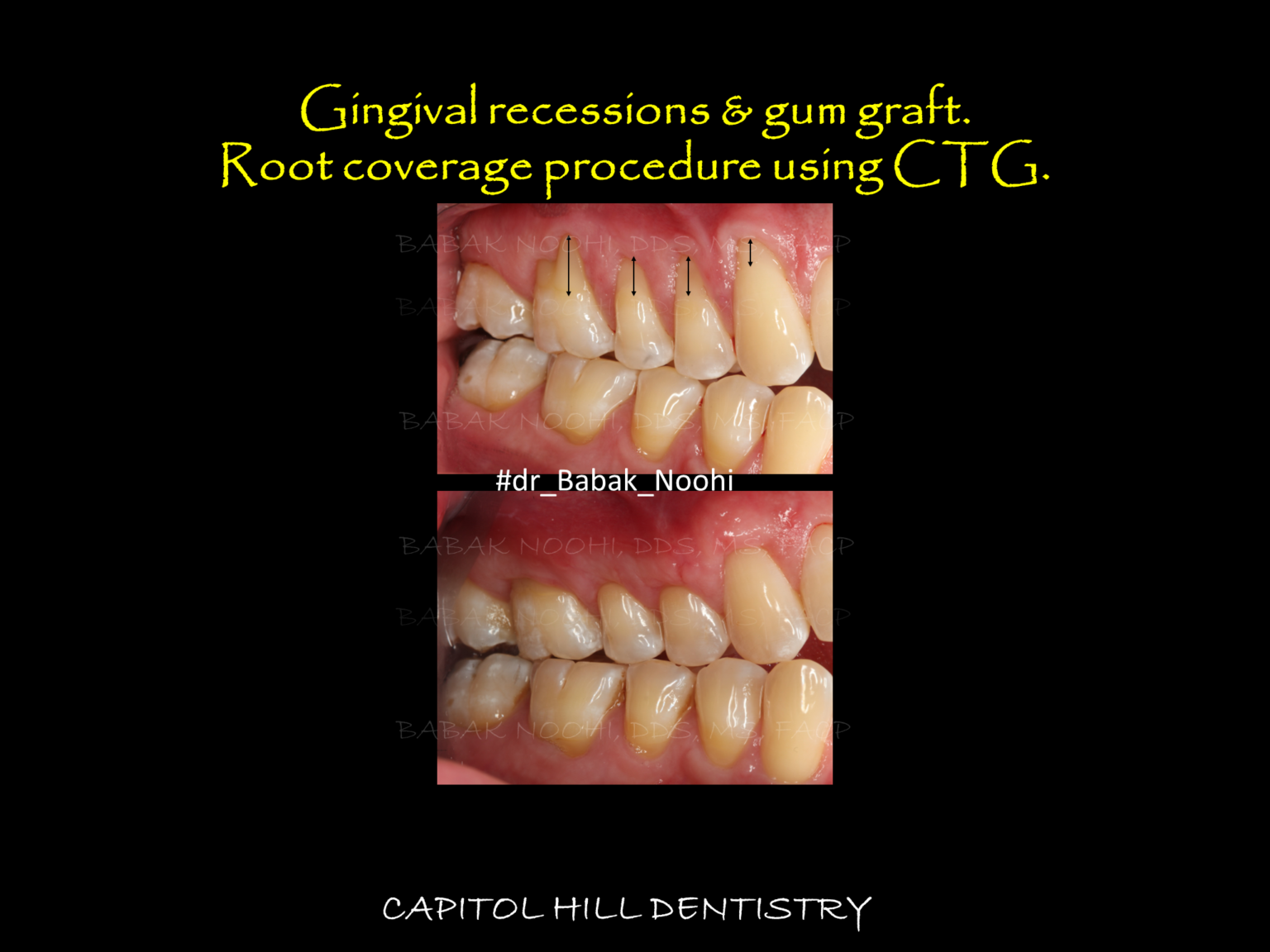 Thick vs. Thin gum: - Capitol Hill Dentistry